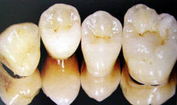 Cermets, prosthetics with cermets - pros and cons, indications, prices ...