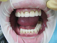 A pin in a tooth, a tooth pin - price, how to do, installation, photo ...