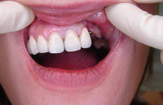 A pin in a tooth, a tooth pin - price, how to do, installation, photo ...