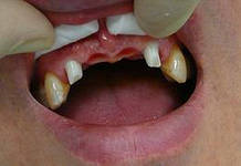 A pin in a tooth, a tooth pin - price, how to do, installation, photo ...