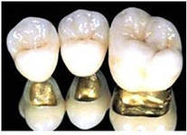 Couronnes en céramique-métal pour les dents (couronnes en métal ...