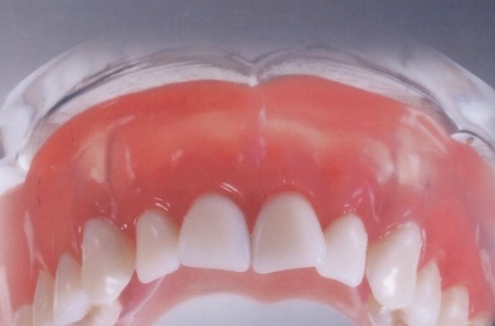 Removable prosthetics, removable dentures - what is it, types, prices ...