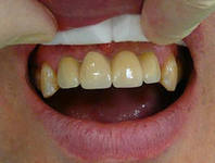 A pin in a tooth, a tooth pin - price, how to do, installation, photo ...