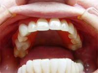 A pin in a tooth, a tooth pin - price, how to do, installation, photo ...
