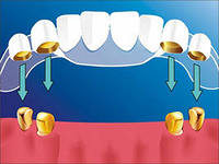 Dentaduras telescópicas, prótesis telescópicas: precios, indicaciones ...