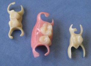 Removable butterfly prosthesis