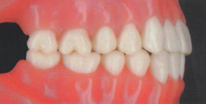 The ideal bite in humans - before and after photos